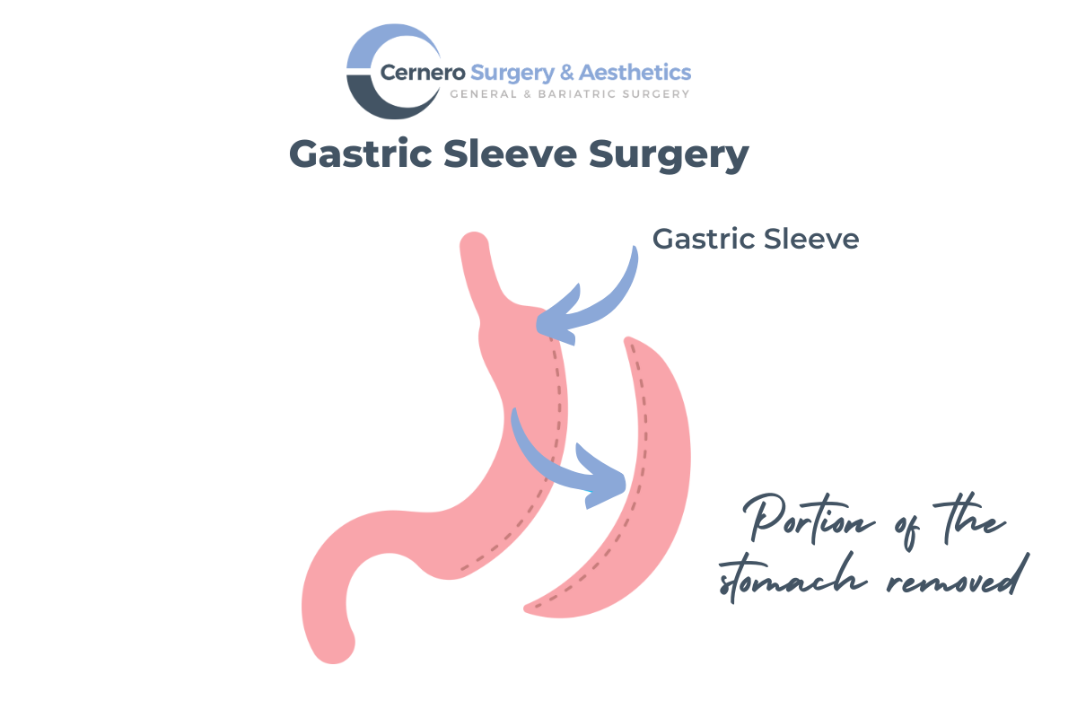 Sleeve Gastrectomy – What you need to know about the “Stomach Sleeve ...